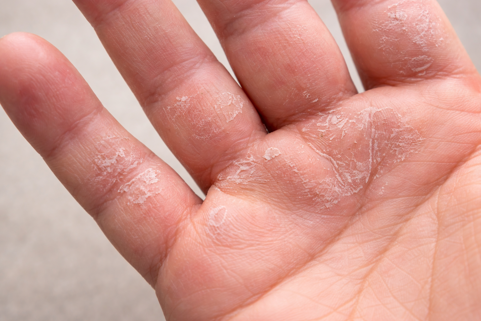 Itchy Palms: 7 Weird Causes You've Never Heard About (But Should ...